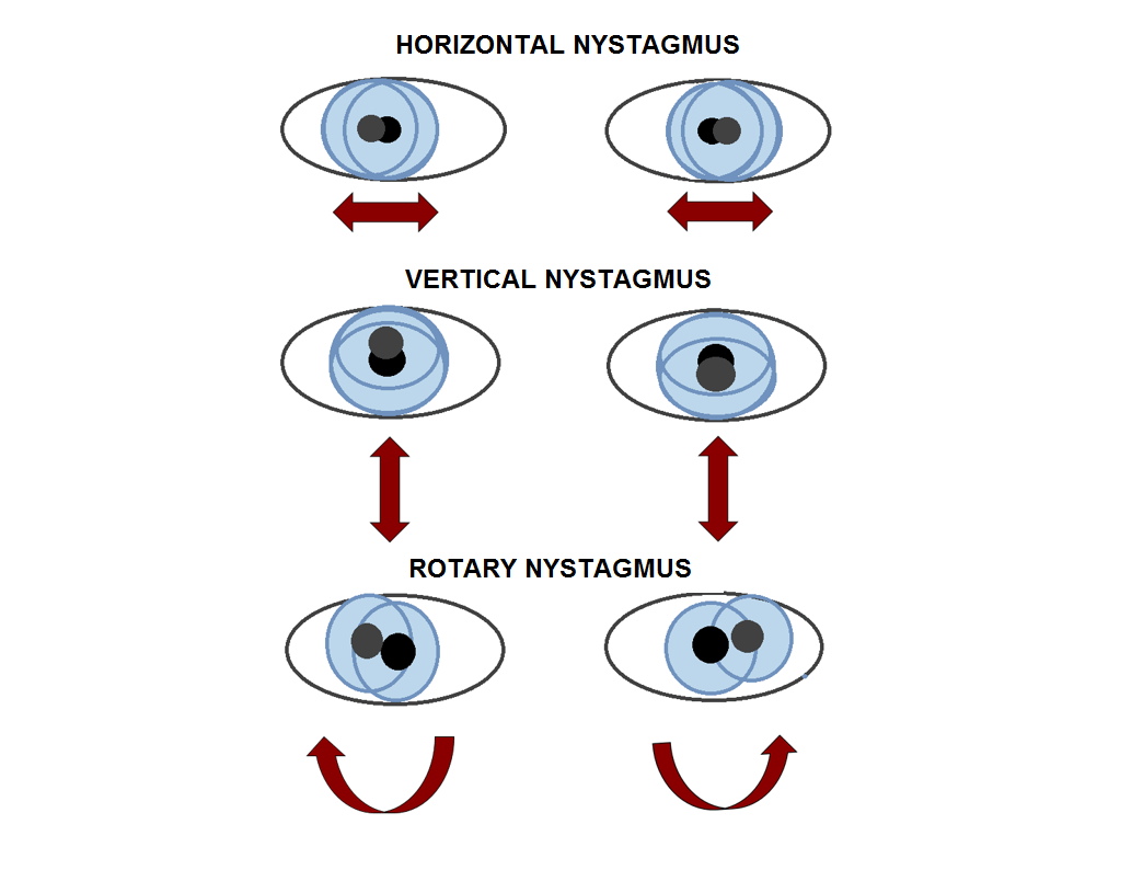 Difference Between Horizontal Nystagmus And Vertical Nystagmus