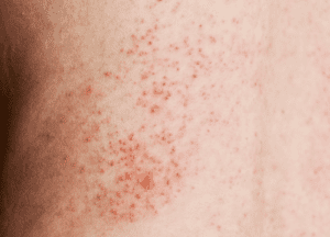 Difference Between Hives and Rash | Difference Between | Hives vs Rash