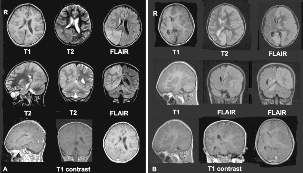 Difference Between Meningitis and Encephalitis | Difference Between ...