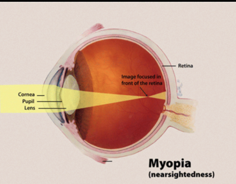 Difference Between Myopia and Hypermetropia | Difference Between