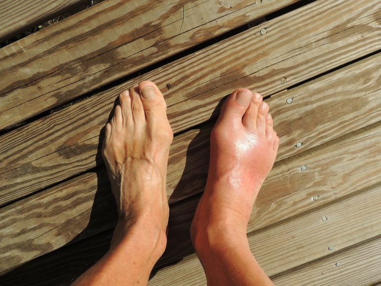 Difference Between Gout and Turf Toe | Difference Between | Gout vs ...