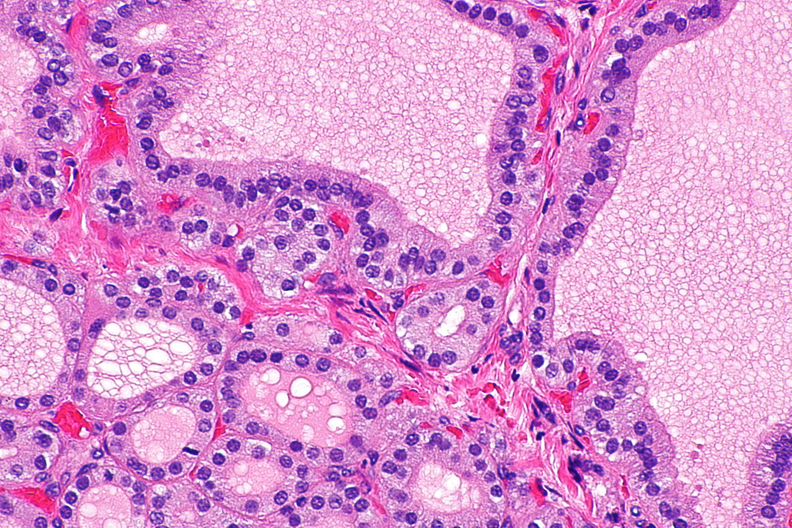 Difference Between Graves’ Disease and Hyperthyroidism | Difference ...