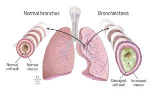 Difference Between Bronchitis and Bronchiectasis | Difference Between