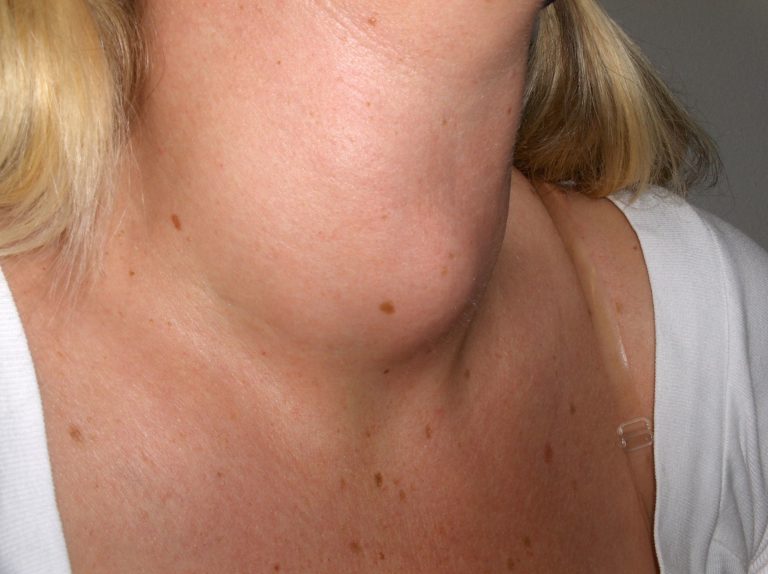 Difference Between Thyroid And Goiter Difference Between Thyroid Vs 3207