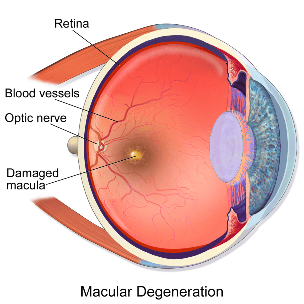 Difference Between Diabetic Retinopathy and Macular Degeneration ...