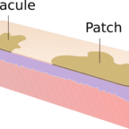 Difference Between | Tag archive for Papule | Papule