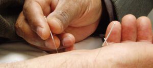 Difference Between Acupuncture and Acupressure | Difference Between ...