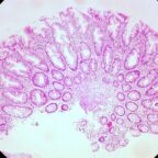 Difference Between | Tag archive for Hyperplastic Polyps | Hyperplastic ...