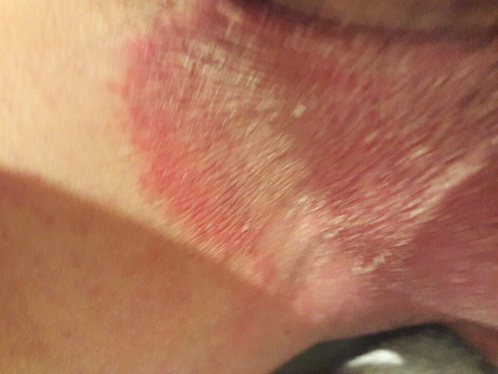 Difference Between Ringworm and Jock Itch | Difference Between