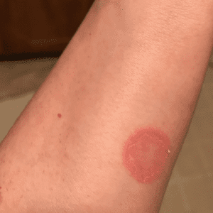 Difference Between Ringworm and Jock Itch | Difference Between