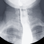 Stricture | Difference Between