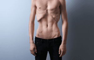Difference Between Cachexia and Anorexia | Difference Between ...