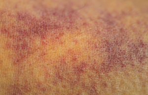 Difference Between Ecchymosis and Hematoma | Difference Between | Ecchymosis vs Hematoma