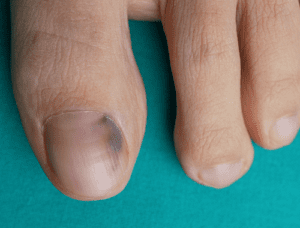 Difference Between Toenail Hematoma and Melanoma | Difference Between