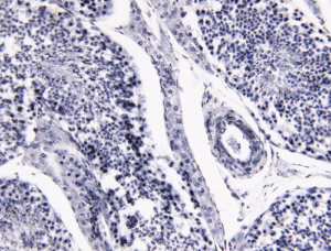 Difference Between Retractile Testis and Undescended Testis ...
