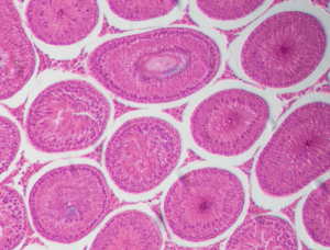Difference Between Retractile Testis and Undescended Testis ...