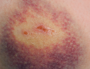 Difference Between Bruising and Necrosis | Difference Between