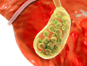 Difference Between Cholecystitis and Cholangitis | Difference Between