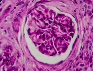 Difference Between Chronic Glomerulonephritis and Chronic Interstitial ...