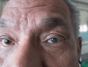 Difference Between Bullous Pemphigoid and Pemphigus Vulgaris ...