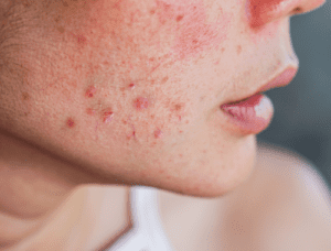 Difference Between Rosacea and Butterfly Rash | Difference Between ...