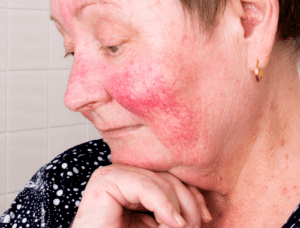 Difference Between Rosacea and Malar Rash | Difference Between