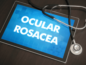 Difference Between Ocular Rosacea and Blepharitis | Difference Between ...