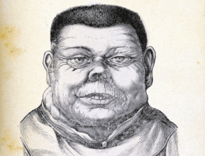 Difference Between Dwarfism and Cretinism | Difference Between ...