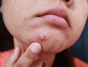 Difference Between Pustules and Cysts | Difference Between | Pustules ...
