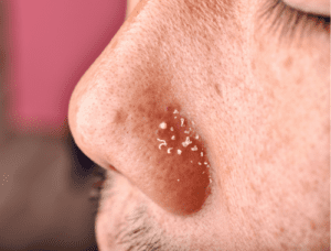 Difference Between Pustules and Whiteheads | Difference Between ...