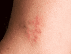 Difference Between Vesicular and Pustular | Difference Between