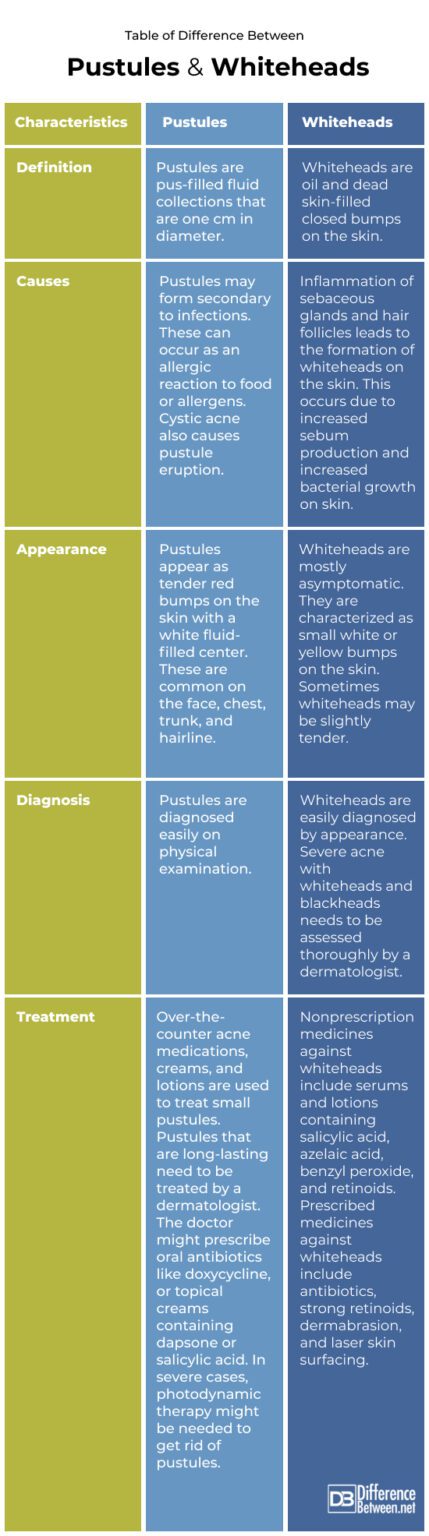 Difference Between Pustules and Whiteheads | Difference Between ...